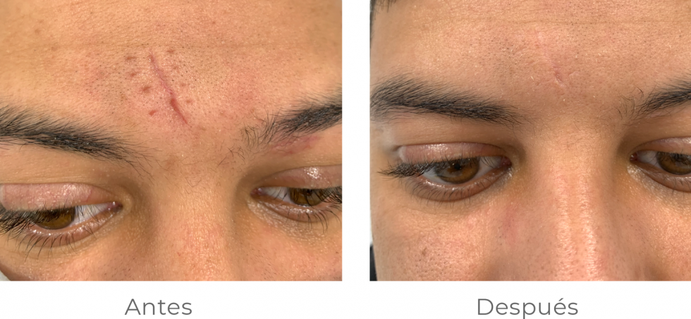 Cicatrices quirúrgicas y traumáticas